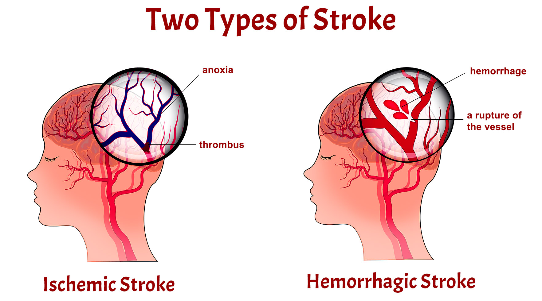 What Are The Different Types Of Stroke 